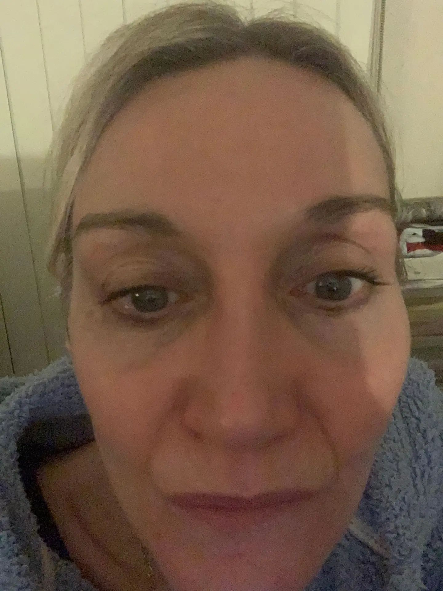 4 weeks post op not happy nose tip is too high nose looks too small ...